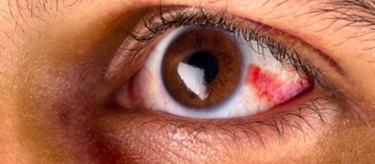 What is Pink Eye? The Real Answer Might Surprise You