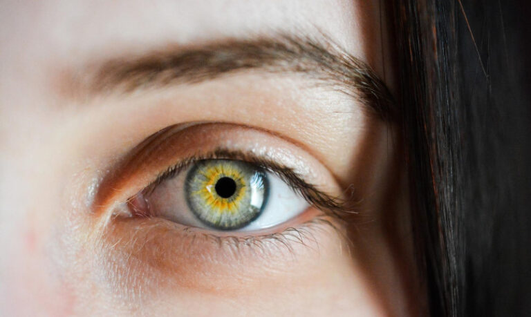 Eye Freckles: What are They & Should You Be Worried?